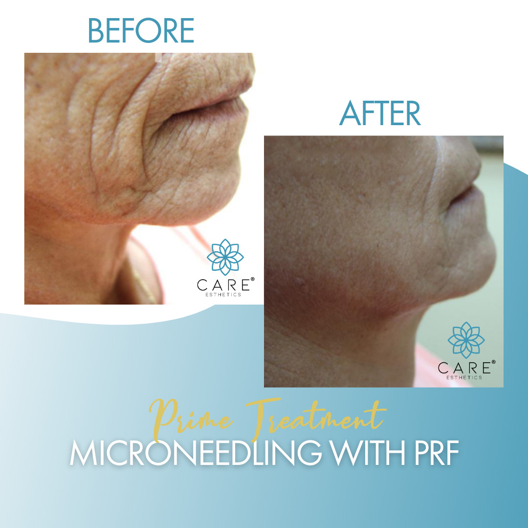 Microneedling with PRF | Advanced PainCare and BioHealth Institute