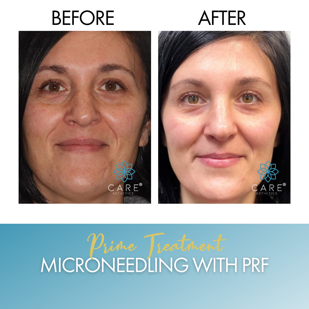 Microneedling with PRF | Advanced PainCare and BioHealth Institute