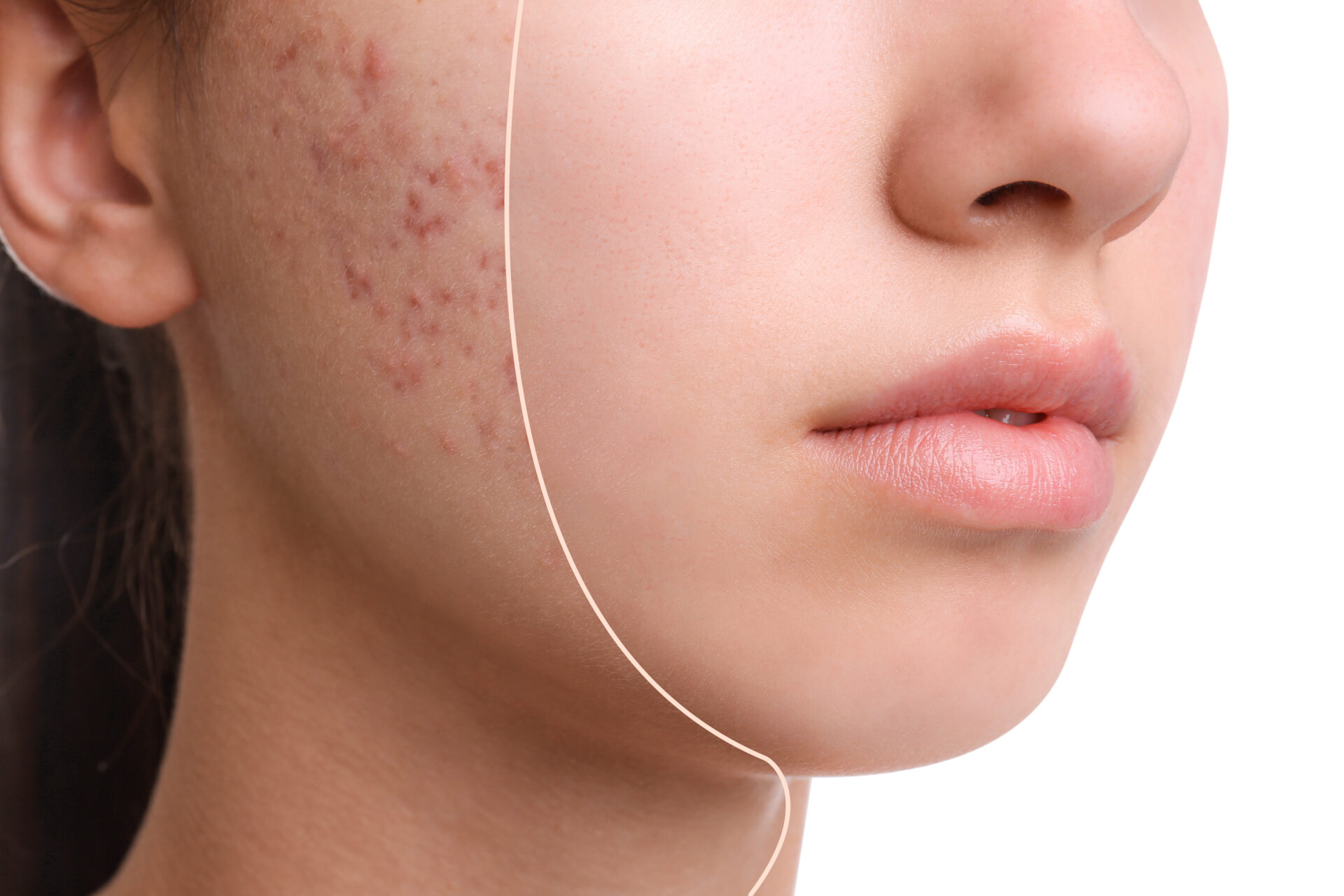 Acne and Acne Scar Treatments | Advanced PainCare and BioHealth Institute